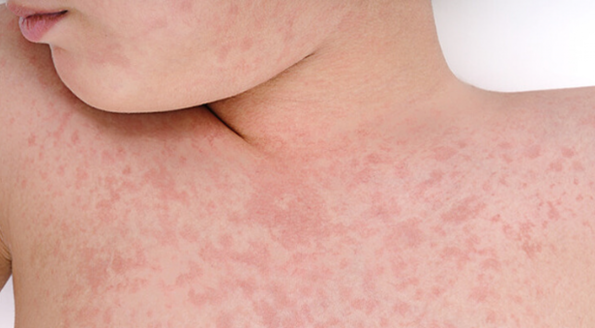 Des traces du virus de la rougeole retrouvées dans les eaux usées de ...