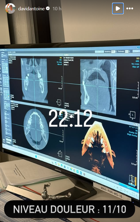« Entre 25 et 30 piqûres » : David Antoine raconte son passage aux urgences après une ...
